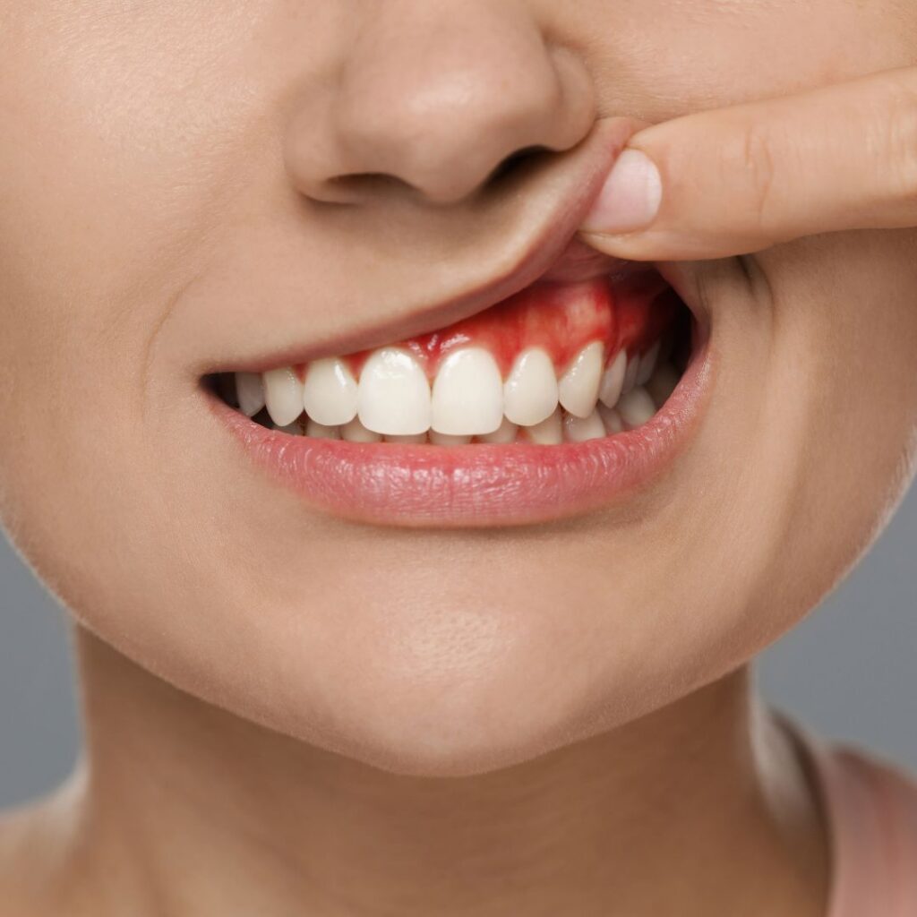 Encías inflamadas. Causas y tratamientos - Odontofamily